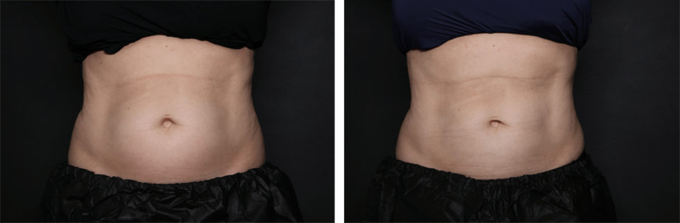 How much does Coolsculpting cost? | Wilmington Dermatology Center