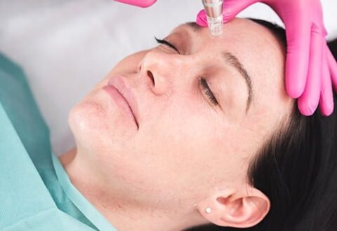 Collagen Pin Microneedling Treatment in Wilmington, NC