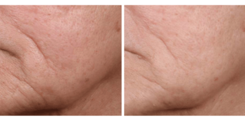 Ellacor®️️️ in Wilmington, NC | Wilmington Dermatology Center